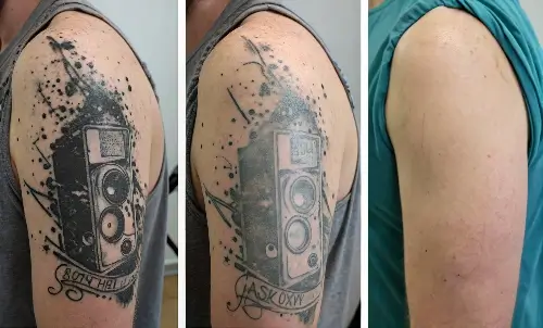 Tattoo Removal Healing Stages with Pictures in the USA - 2025